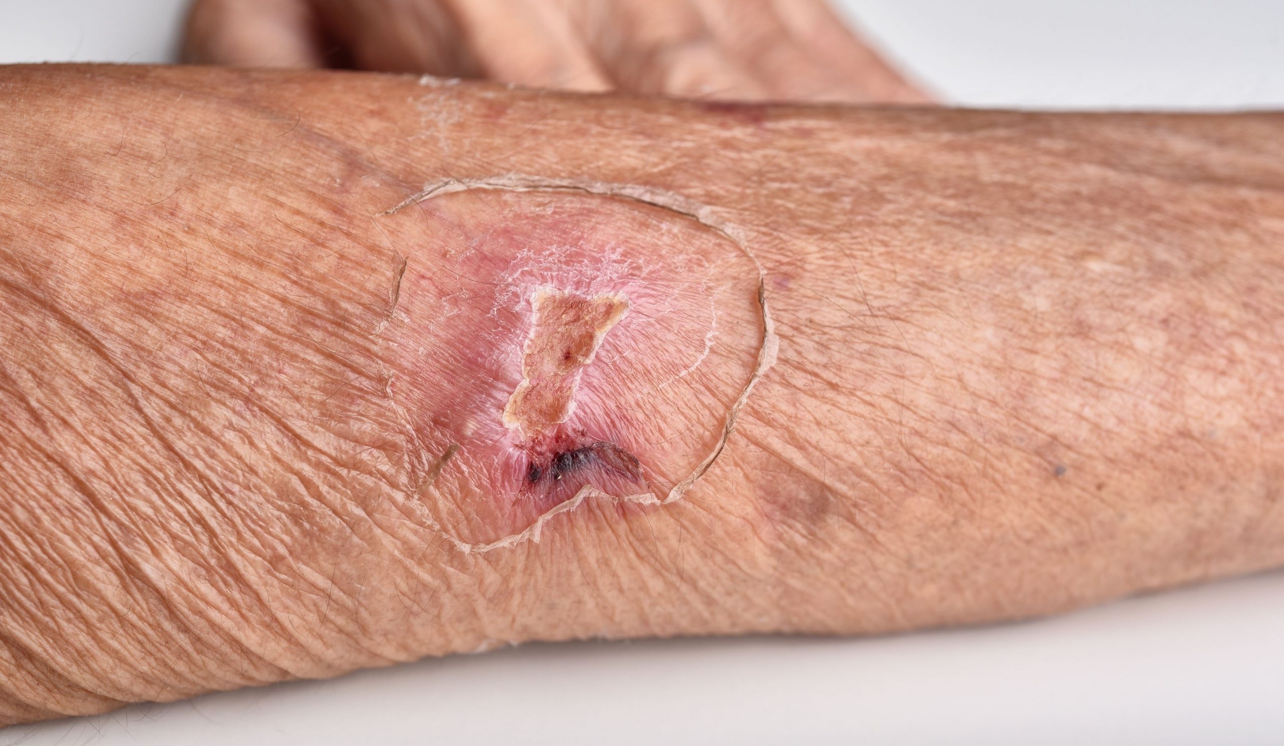 Wunden und Scham - warum viele Menschen zu spät Hilfe holen